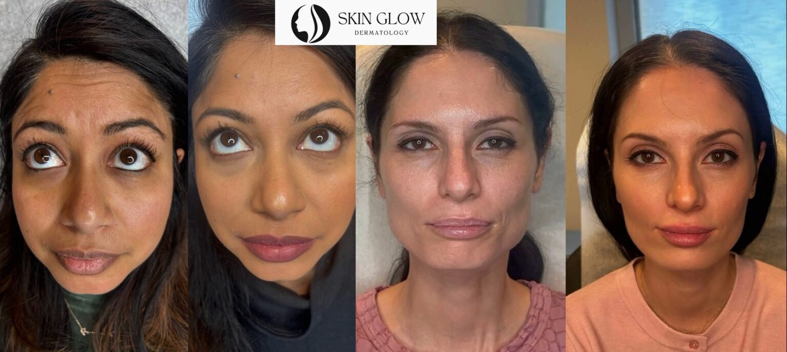 Affordable BOTOX® Treatment in Brooklyn: Full Face BOTOX Injections ...
